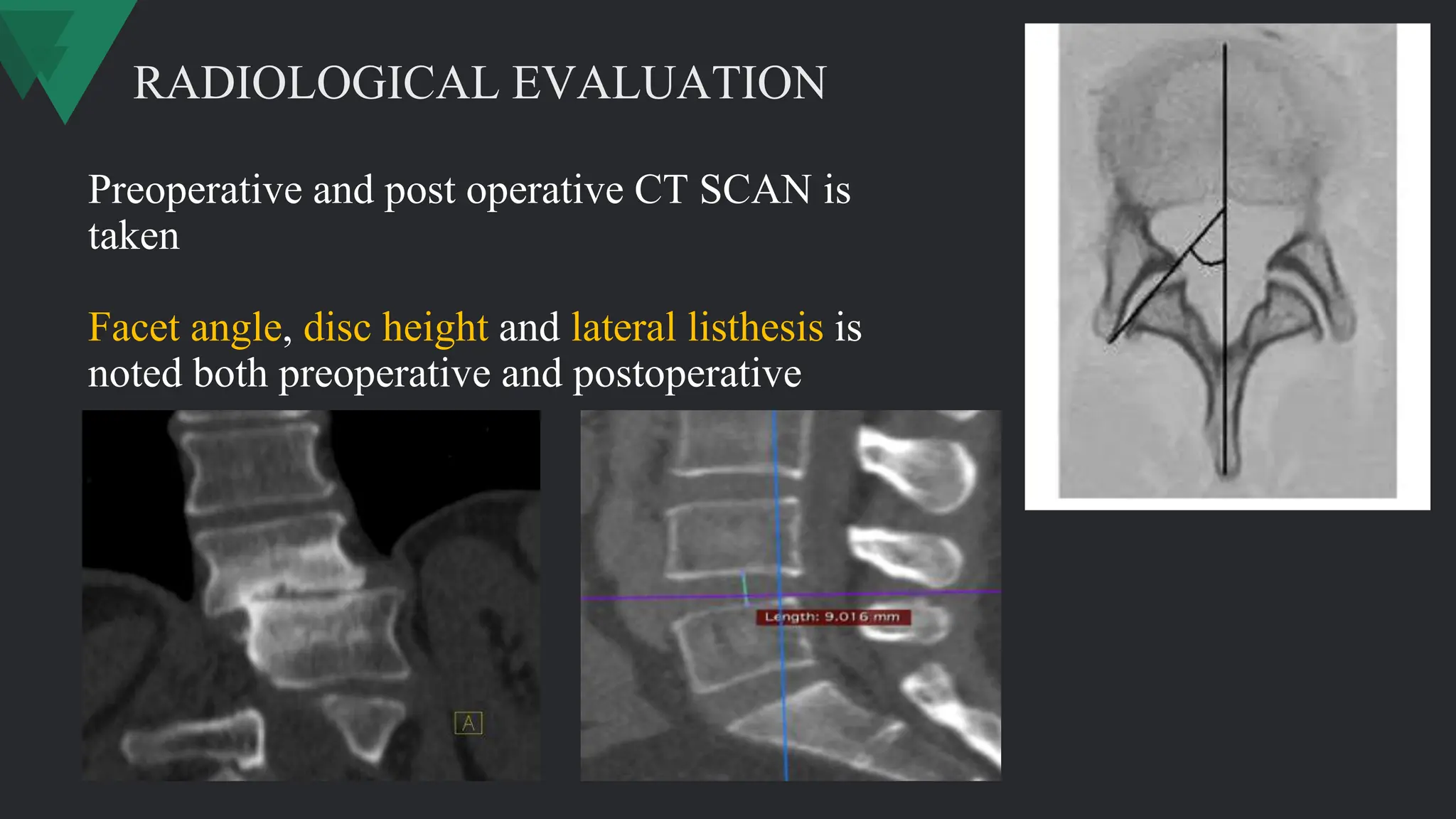 Fusion surgery for Spondylolisthesis.pptx