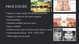 Fusion surgery for Spondylolisthesis.pptx