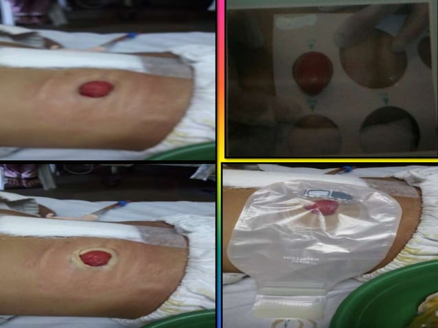 Most common ileostomy complications | PPTX | Digestive Disorders ...