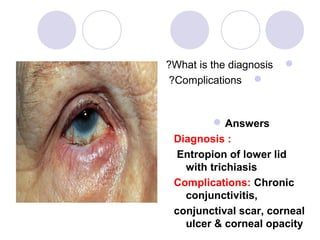 Most common opthalmology slides with anwers in uhs ospe | PPT