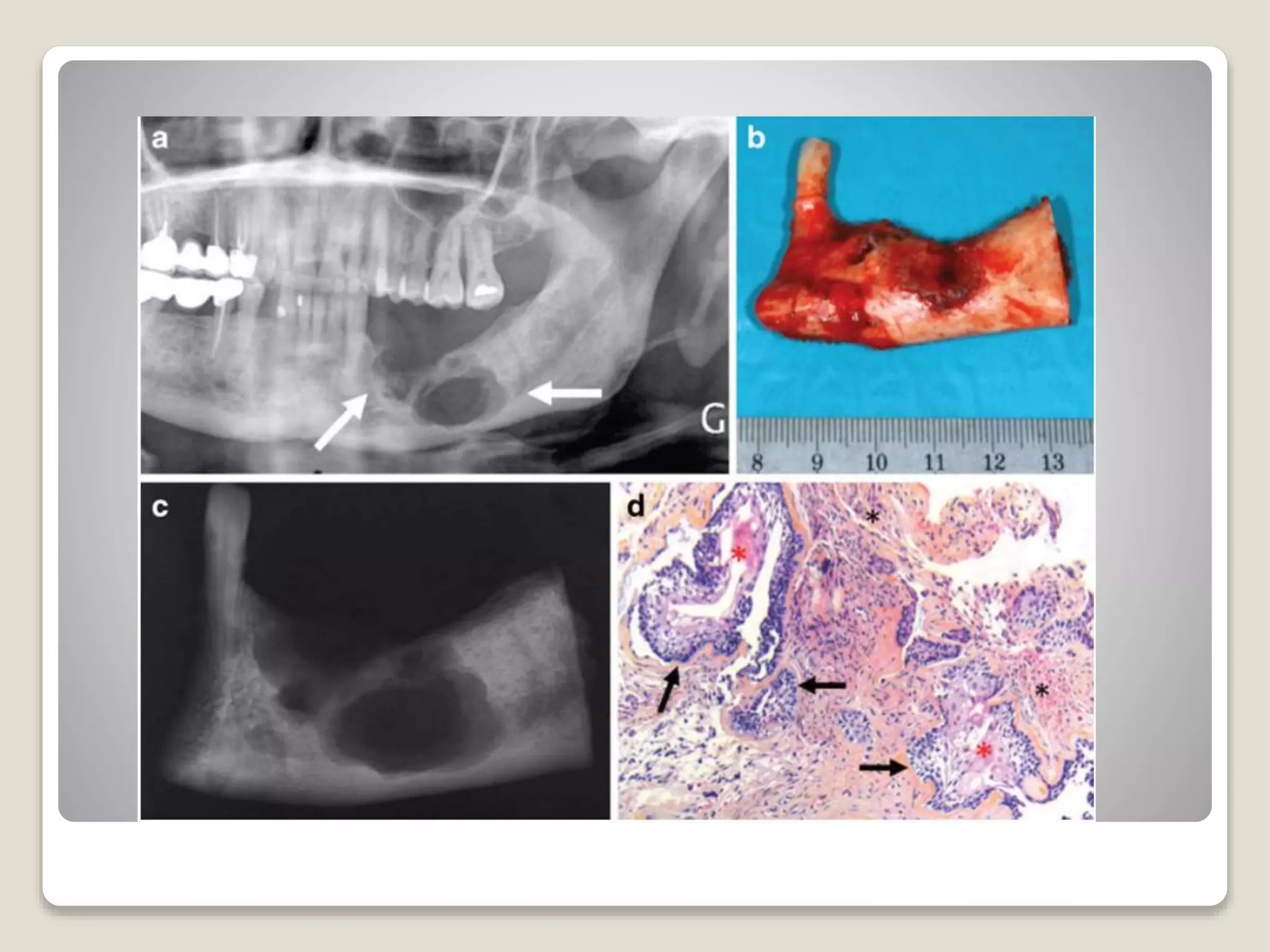 Cyst/pathologies in mandible DDX | PPTX | Dental Health | Diseases and ...