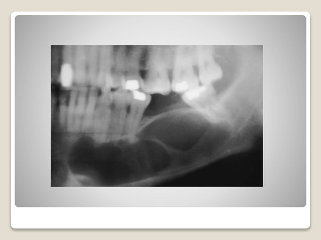 Cyst/pathologies in mandible DDX | PPTX | Dental Health | Diseases and ...