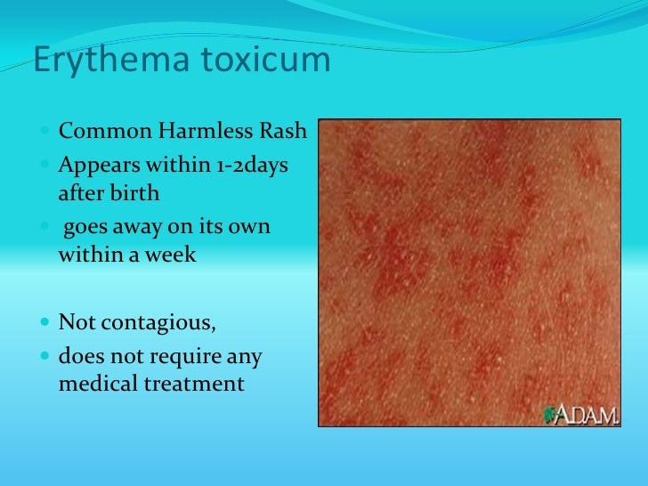 NEW BORN CARE AND INFECTIONS