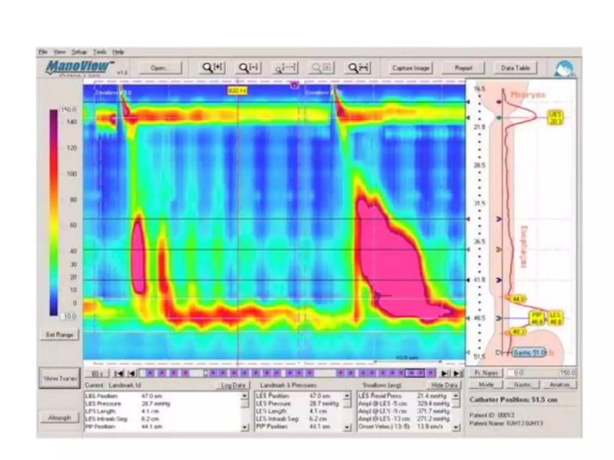 Motility disorders of esophagus | PPTX | Digestive Disorders | Diseases ...