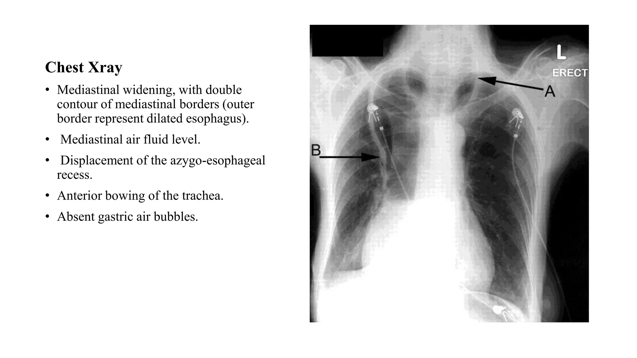 Motility disorders of esophagus new | PPTX