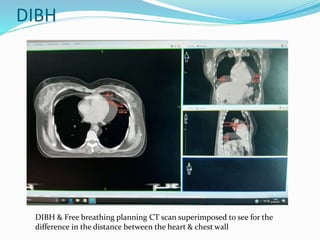 Motion management in Radiation Oncology - 2020 | PPTX