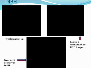 Motion management in Radiation Oncology - 2020 | PPTX