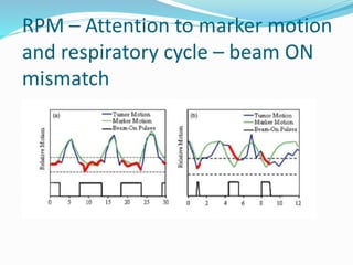 Motion management in Radiation Oncology - 2020 | PPTX