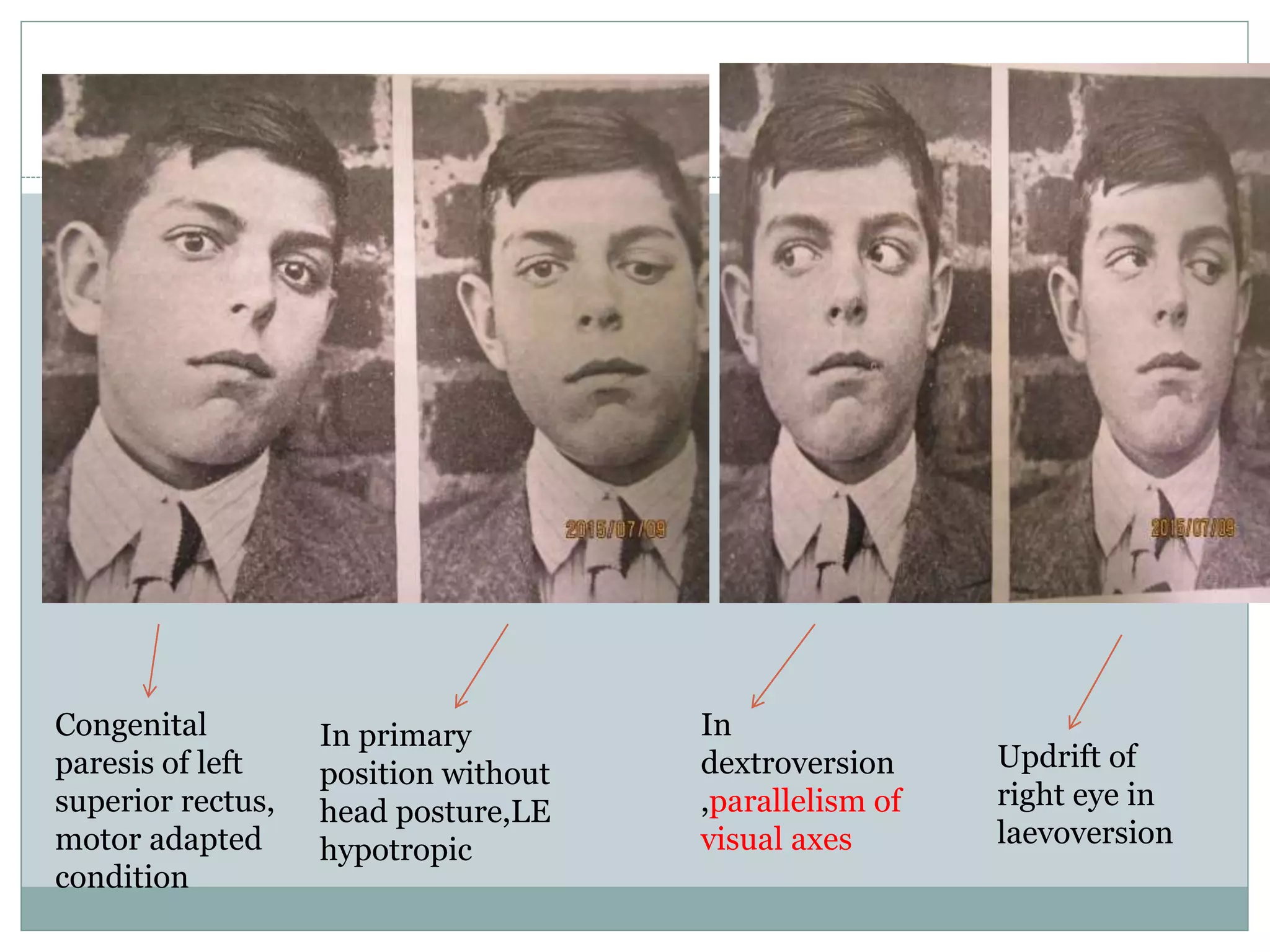 Motor adaptation in paretic and nonparetic strabismus | PPTX