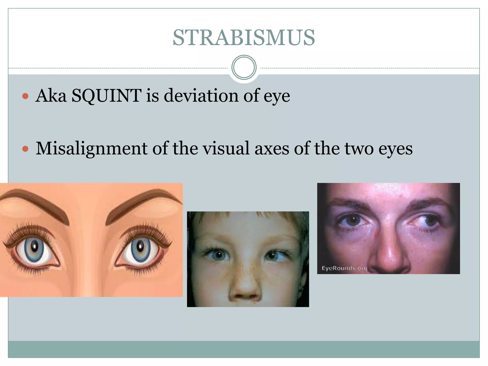 Motor adaptation in paretic and nonparetic strabismus | PPTX