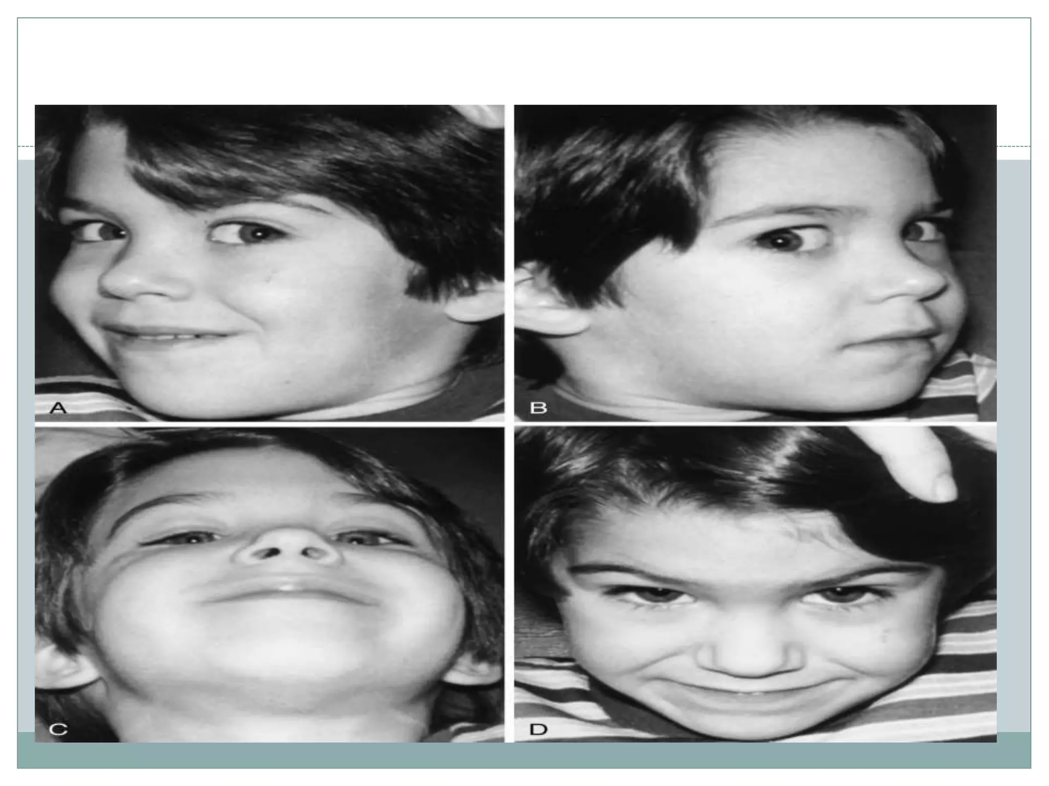 Motor adaptation in paretic and nonparetic strabismus | PPTX