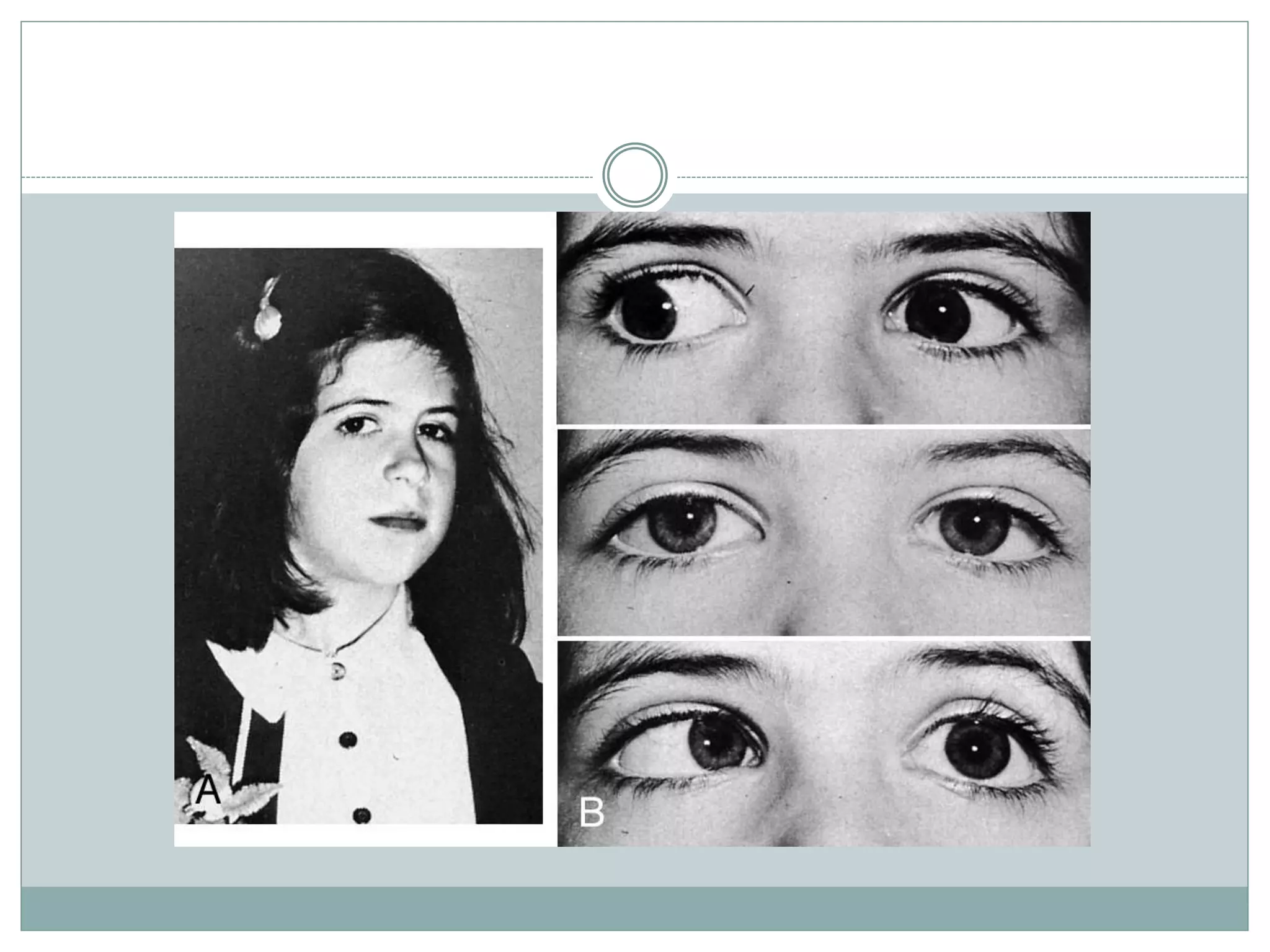 Motor adaptation in paretic and nonparetic strabismus | PPTX
