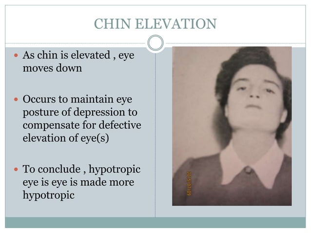 Motor adaptation in paretic and nonparetic strabismus | PPTX | Eye and ...