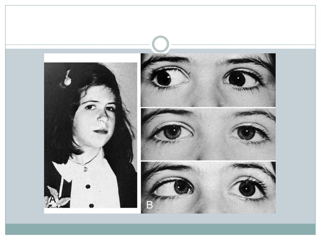 Motor adaptation in paretic and nonparetic strabismus | PPTX | Eye and ...