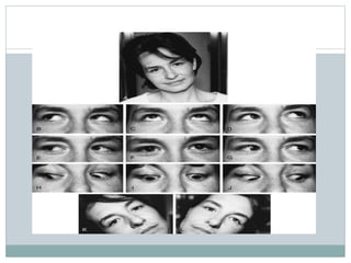 Motor adaptation in paretic and nonparetic strabismus | PPTX