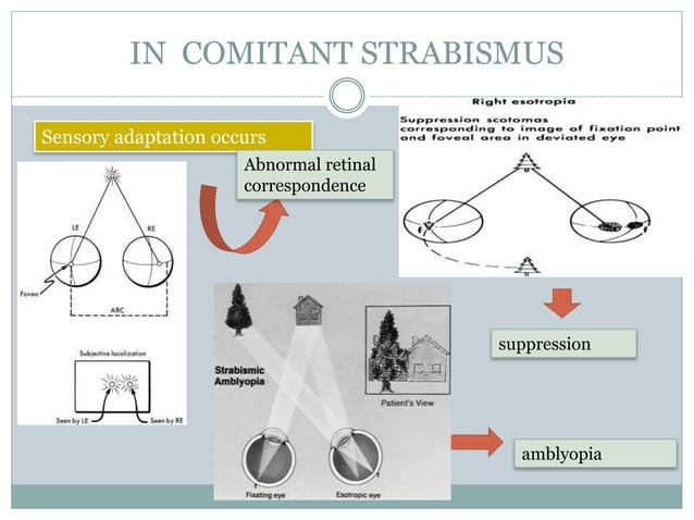 Motor adaptation in paretic and nonparetic strabismus | PPTX | Eye and ...