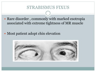 Motor adaptation in paretic and nonparetic strabismus | PPTX
