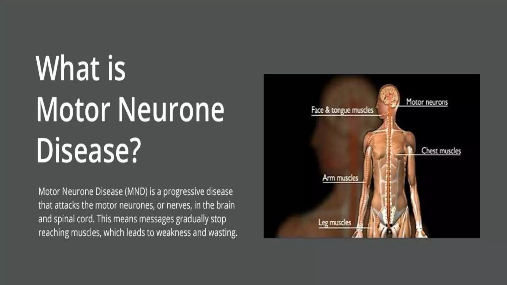 Whats your Moto ? - (Motor neuron disease) | PPTX