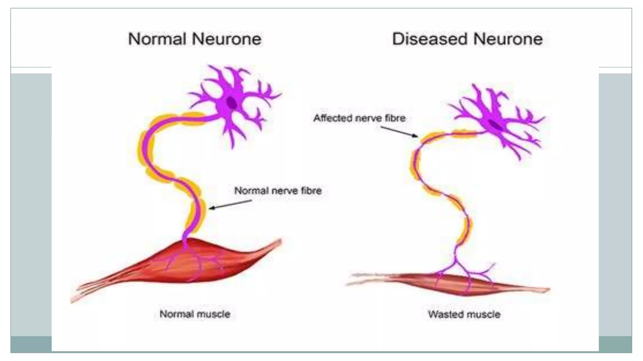 Motor neuron disease.pptx new | PPTX | Brain and Nervous System ...
