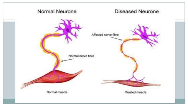Motor neuron disease.pptx new | PPT