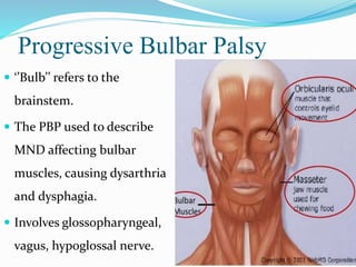 Motor neuron disease | PPT