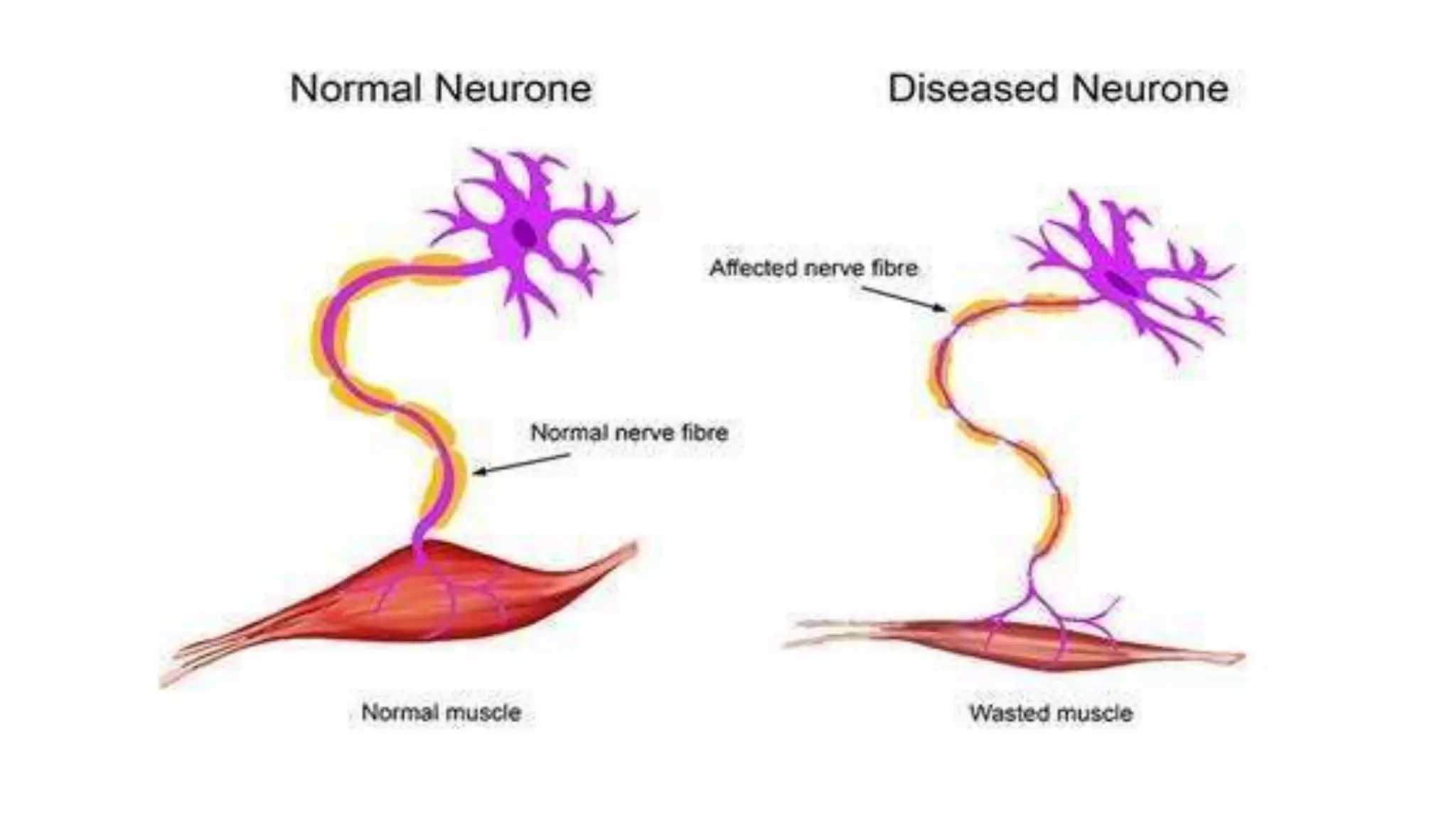 MOTOR NEURON DISEASE.pptx