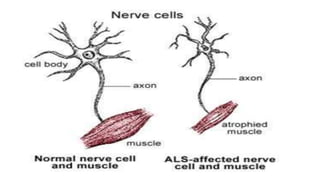 MOTOR NEURON DISEASE.pptx