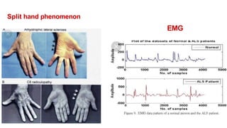 Motor neuron diseases.pdf | Physical Therapy | Wellness