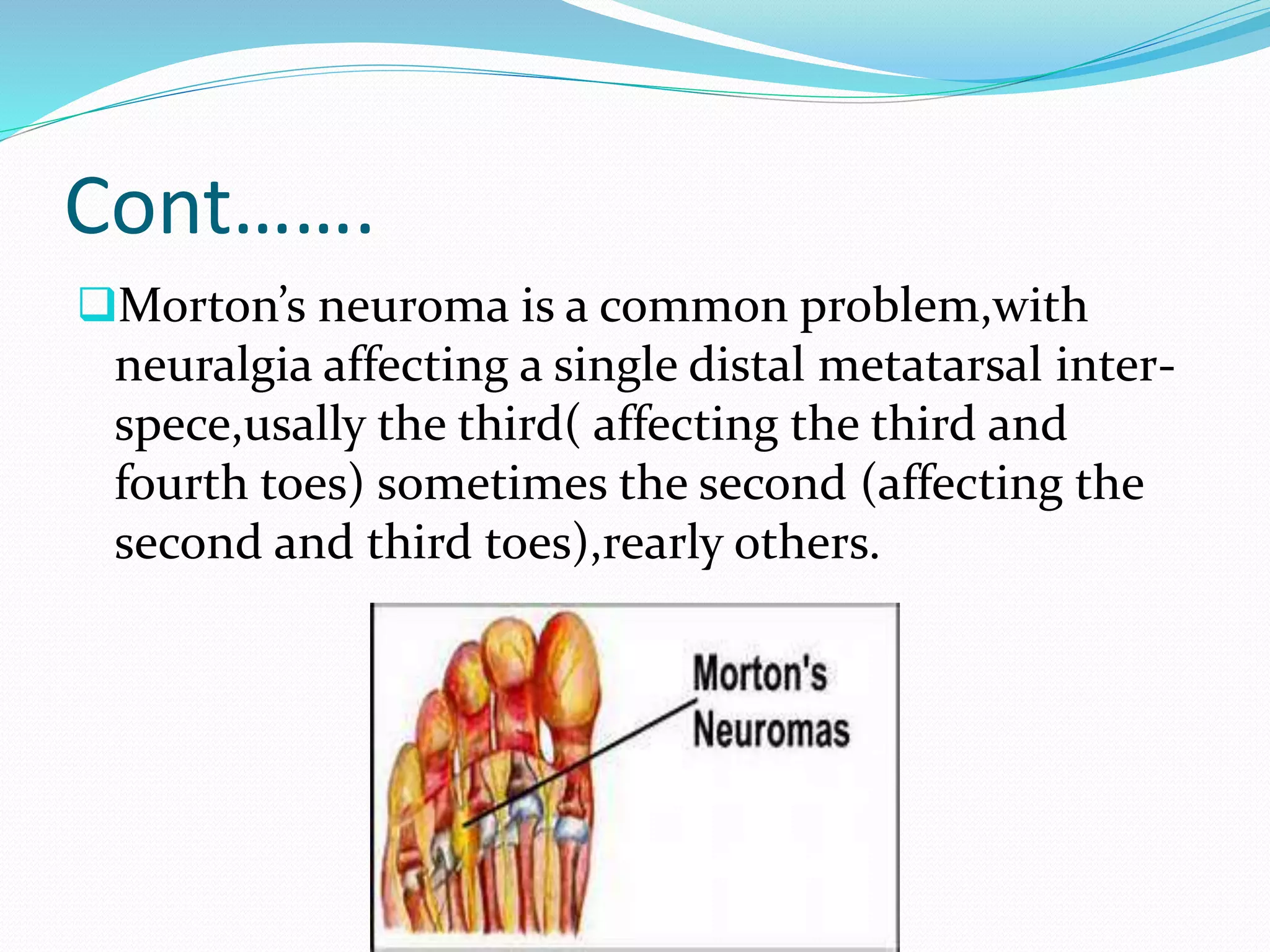 Motorn's neuroma | PPTX