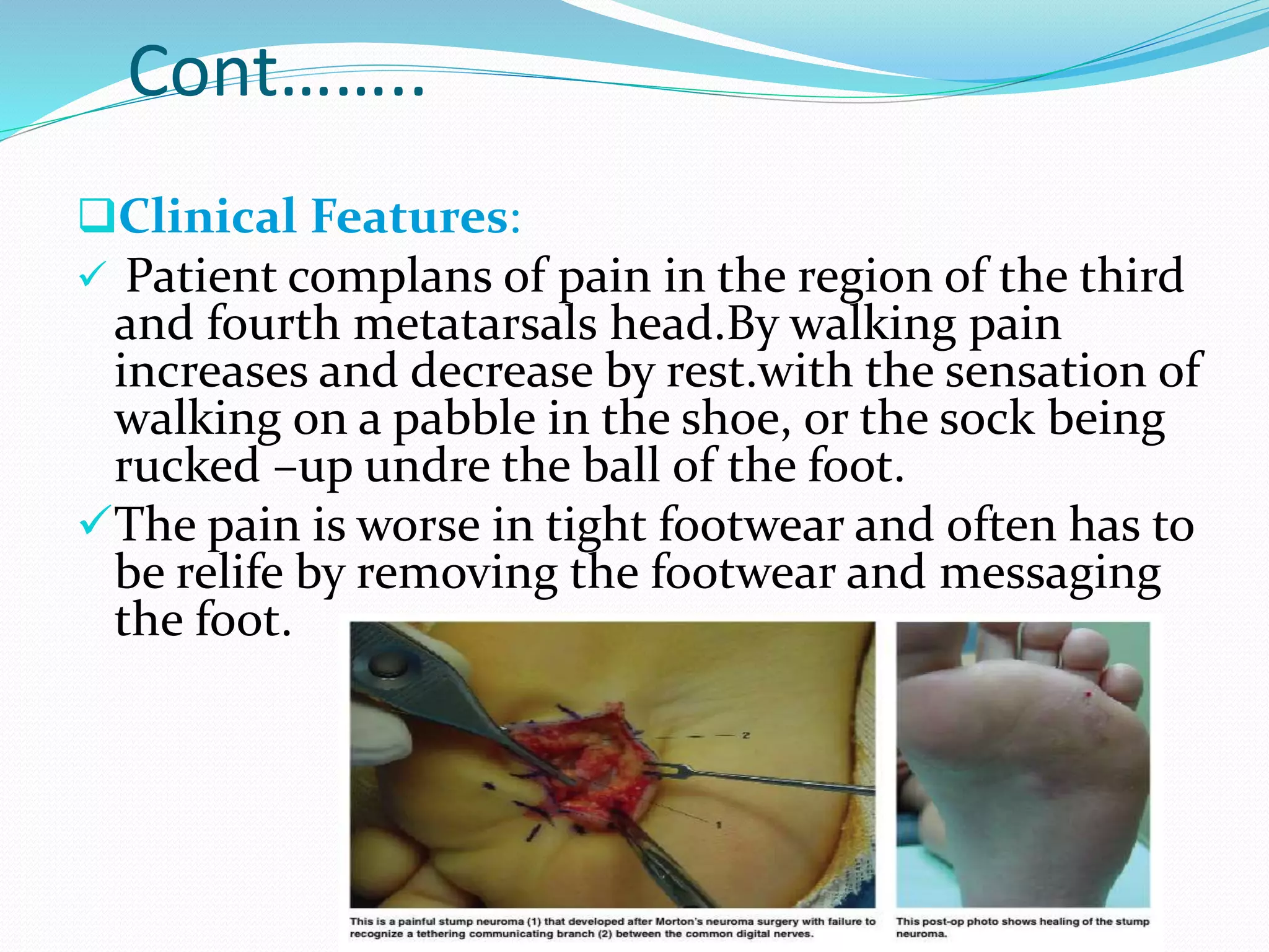 Motorn's neuroma | PPTX