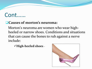 Motorn's neuroma | PPTX