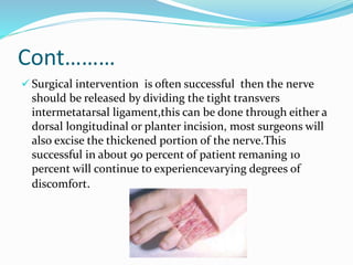Motorn's neuroma | PPTX