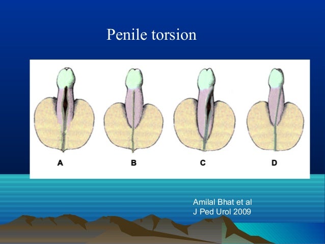 Rational approach in management of hypospadias