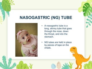 NGT FEEDING | PPTX