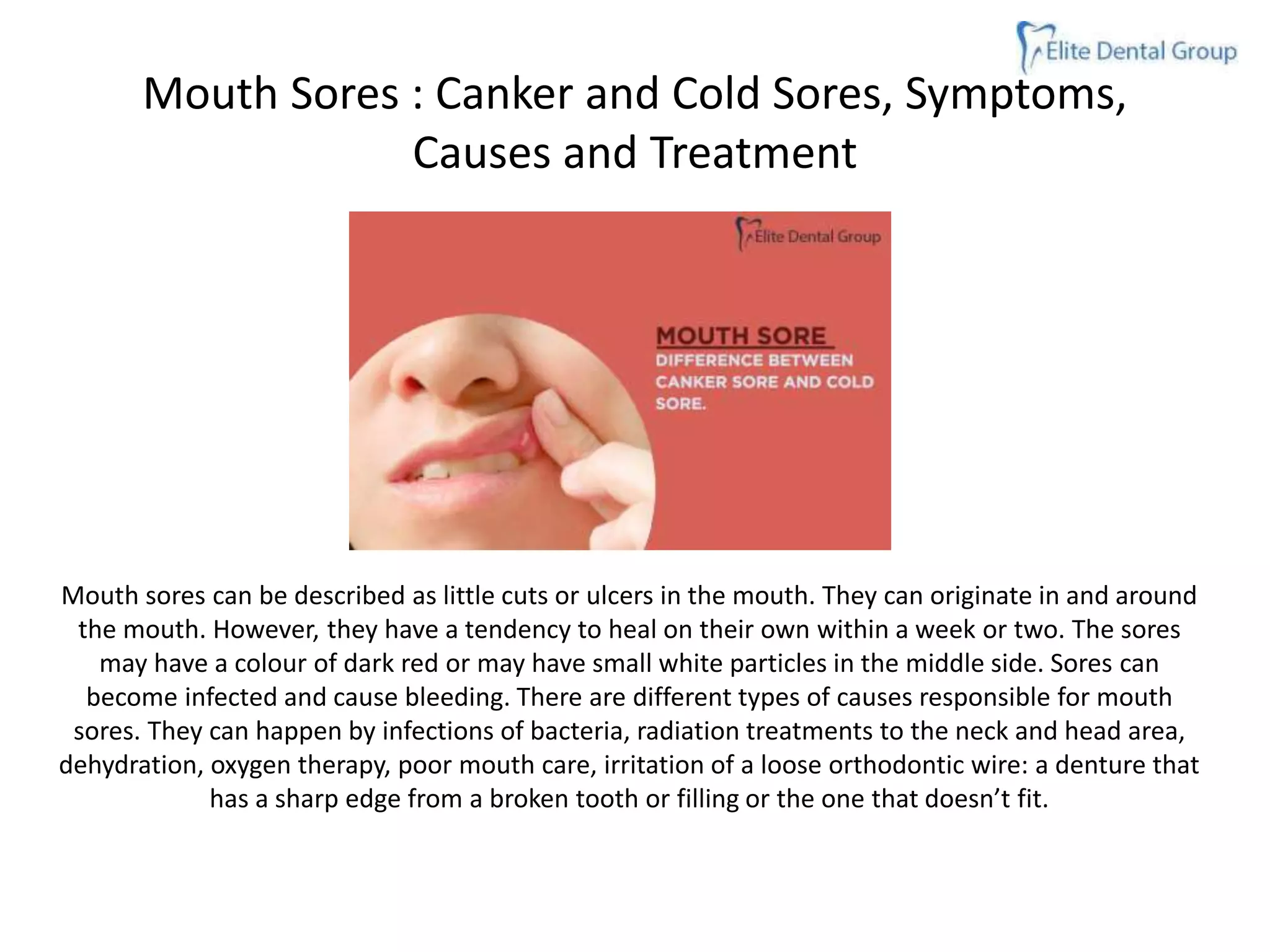 MOUTH SORES : CANKER AND COLD SORES, SYMPTOMS, CAUSES AND TREATMENT | PPTX