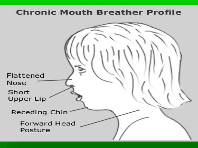 Mouth breathing | PPT | Ear, Nose and Throat Conditions | Diseases and ...