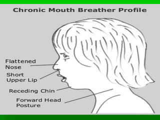 Mouth Breather Profile
