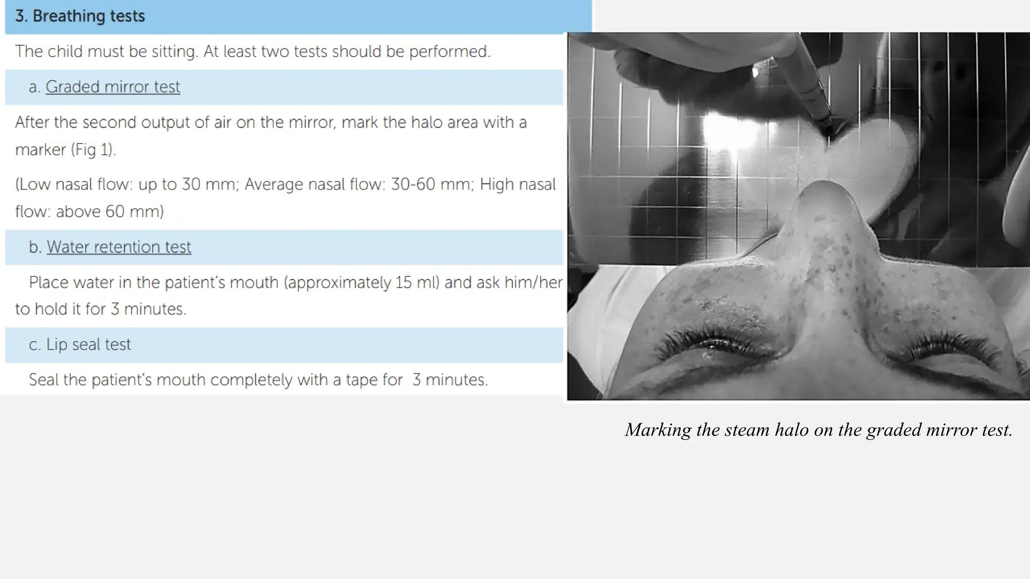 Mouth breathing habit pathophysiology and treament.pptx