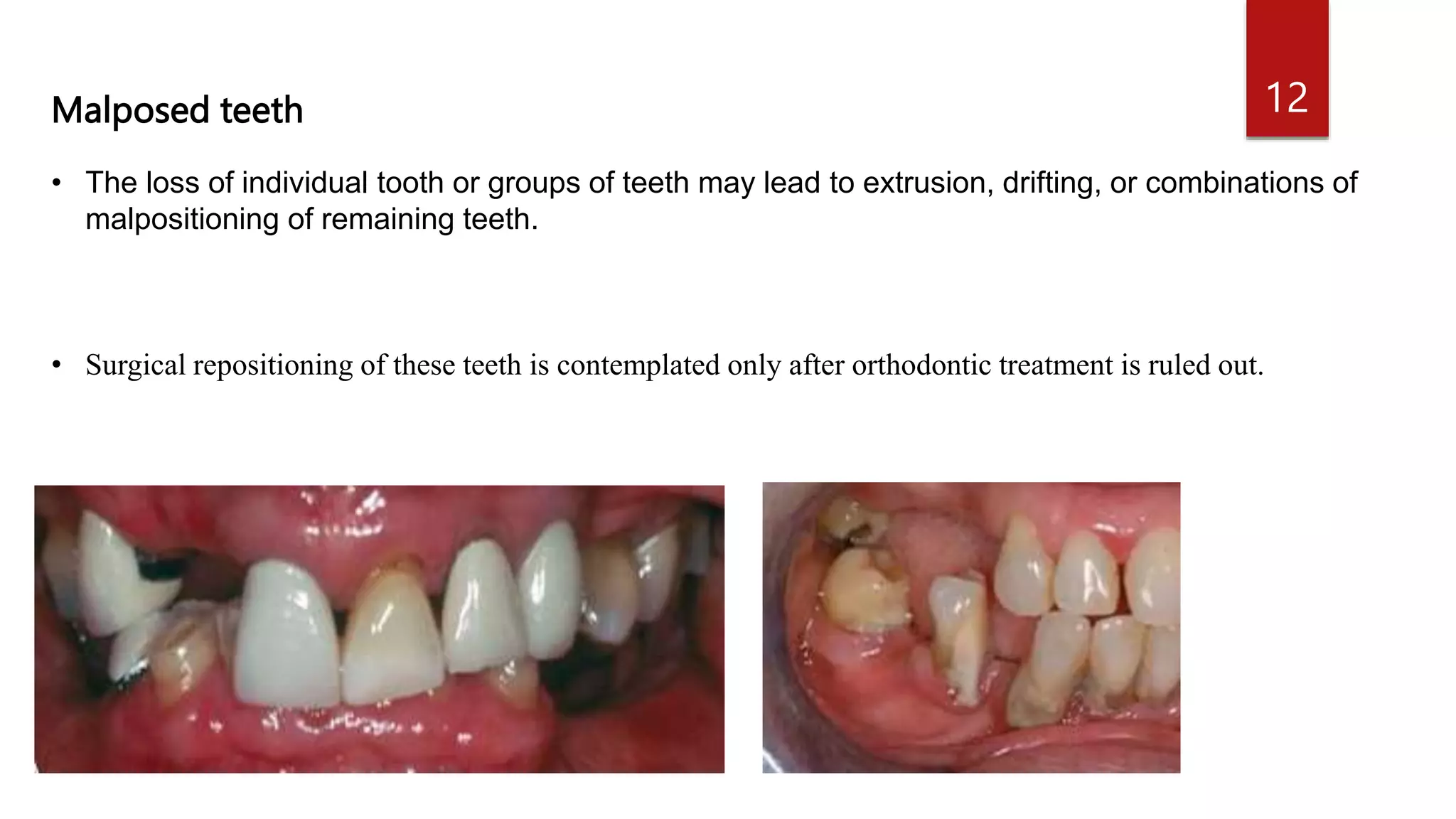 MOUTH PREPARATION FOR REMOVABLE PARTIAL DENTURES.pptx