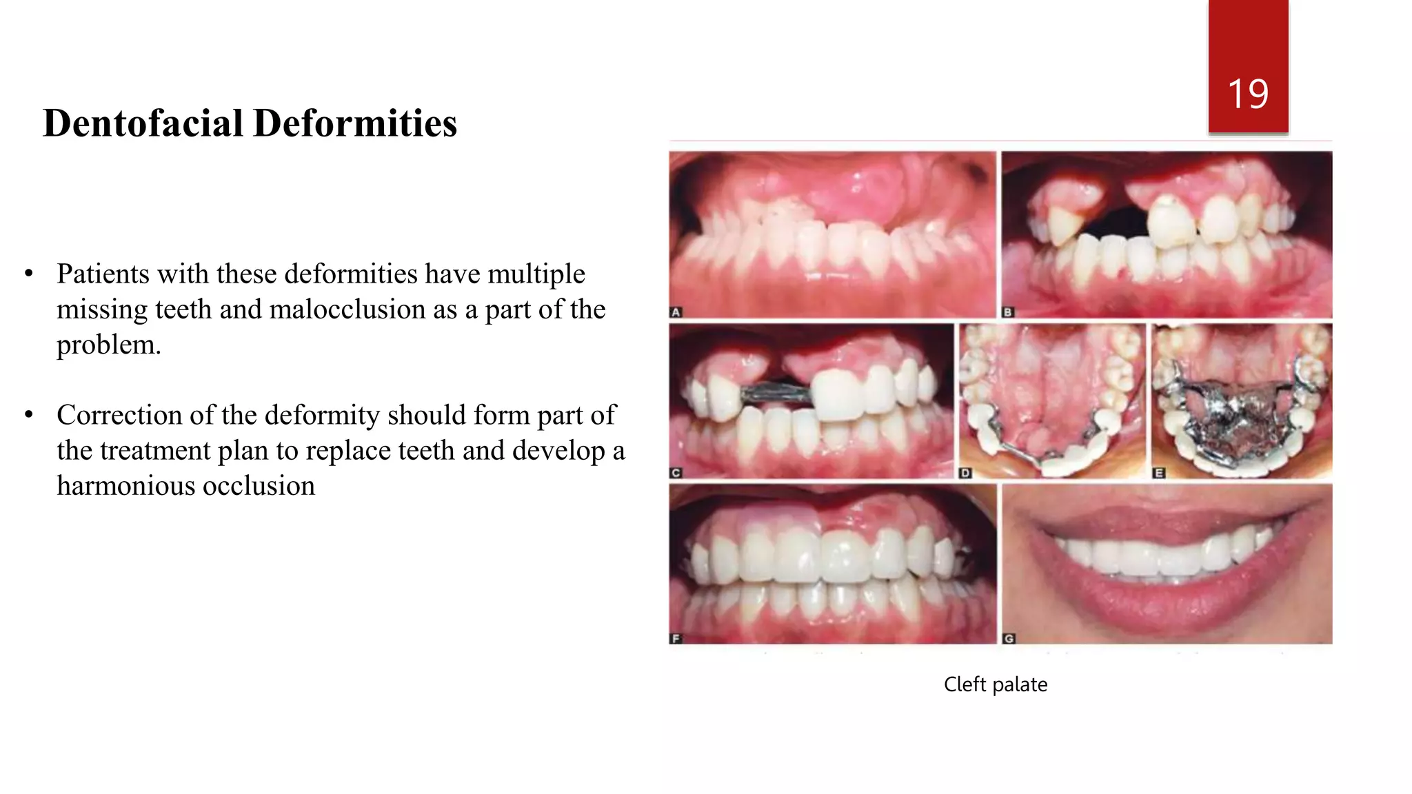 MOUTH PREPARATION FOR REMOVABLE PARTIAL DENTURES.pptx