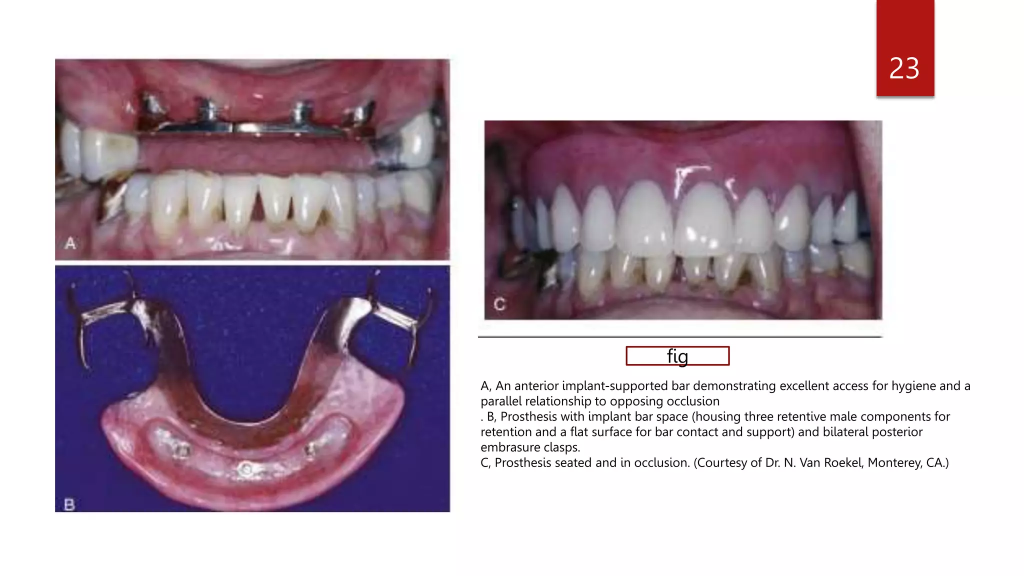 MOUTH PREPARATION FOR REMOVABLE PARTIAL DENTURES.pptx