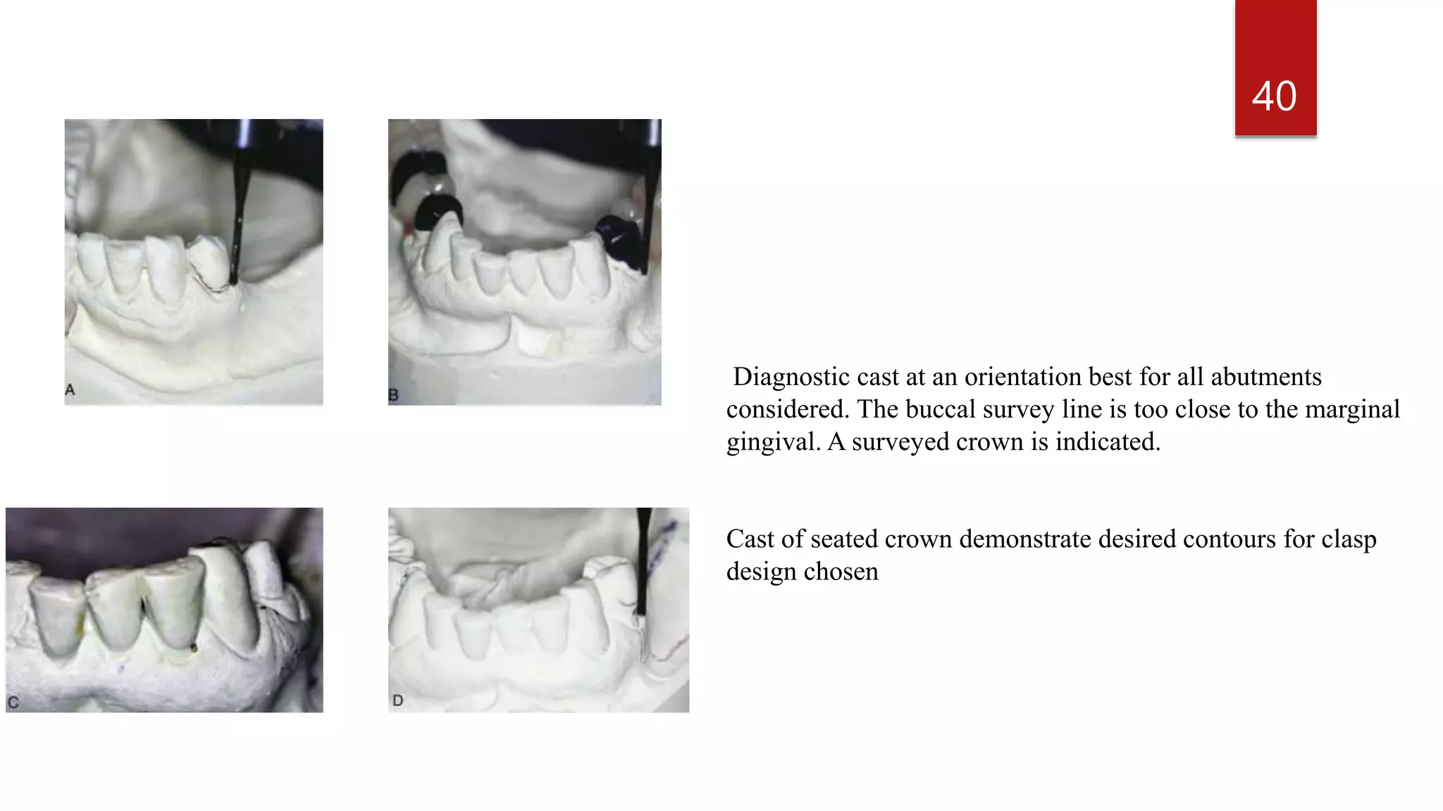 MOUTH PREPARATION FOR REMOVABLE PARTIAL DENTURES.pptx