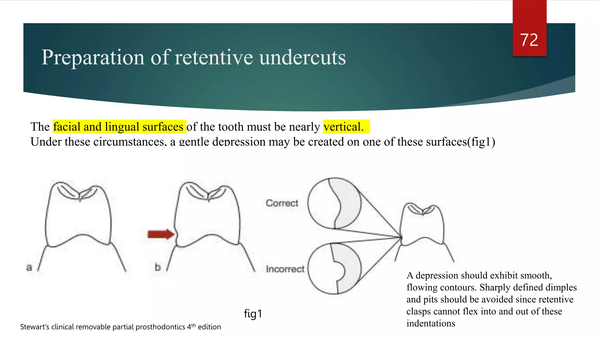 MOUTH PREPARATION FOR REMOVABLE PARTIAL DENTURES.pptx