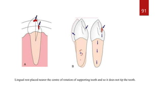 MOUTH PREPARATION FOR REMOVABLE PARTIAL DENTURES.pptx