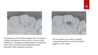 MOUTH PREPARATION FOR REMOVABLE PARTIAL DENTURES.pptx