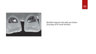 MOUTH PREPARATION FOR REMOVABLE PARTIAL DENTURES.pptx