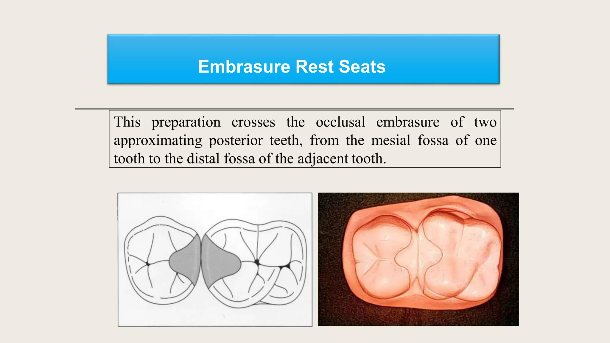 Mouth Preparation For Removable Partial Dentures.pptx