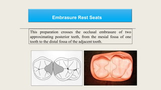 Mouth Preparation For Removable Partial Dentures.pptx