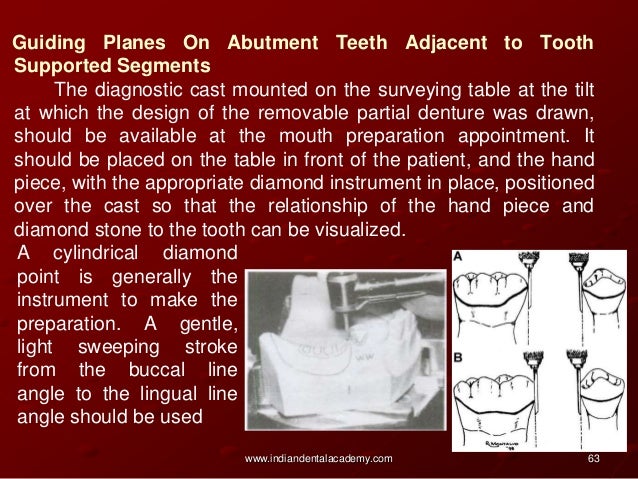 Mouth preparation for rpd /certified fixed orthodontic courses by Ind…