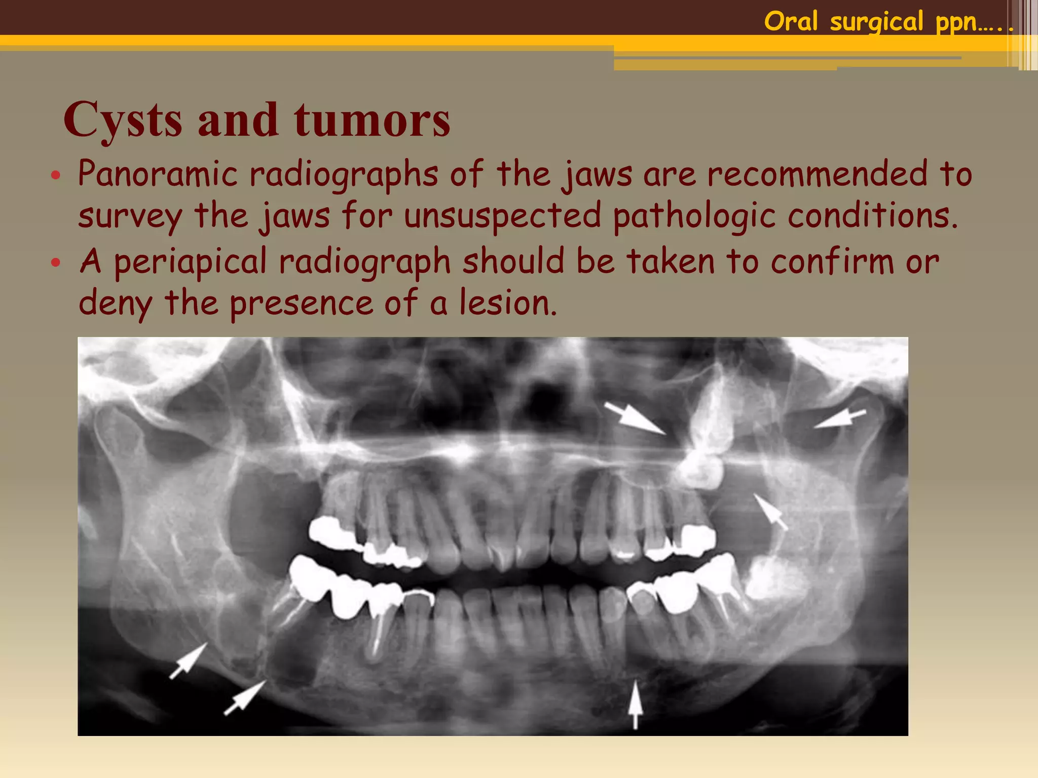 mouth preparation for rpd (2).pptx